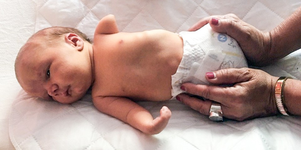 After her baby was born without legs and an arm, a mother witnessed a ...