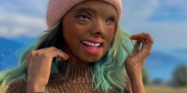 Attacked with acid as a baby, Anmol Rodriguez overcomes and inspires